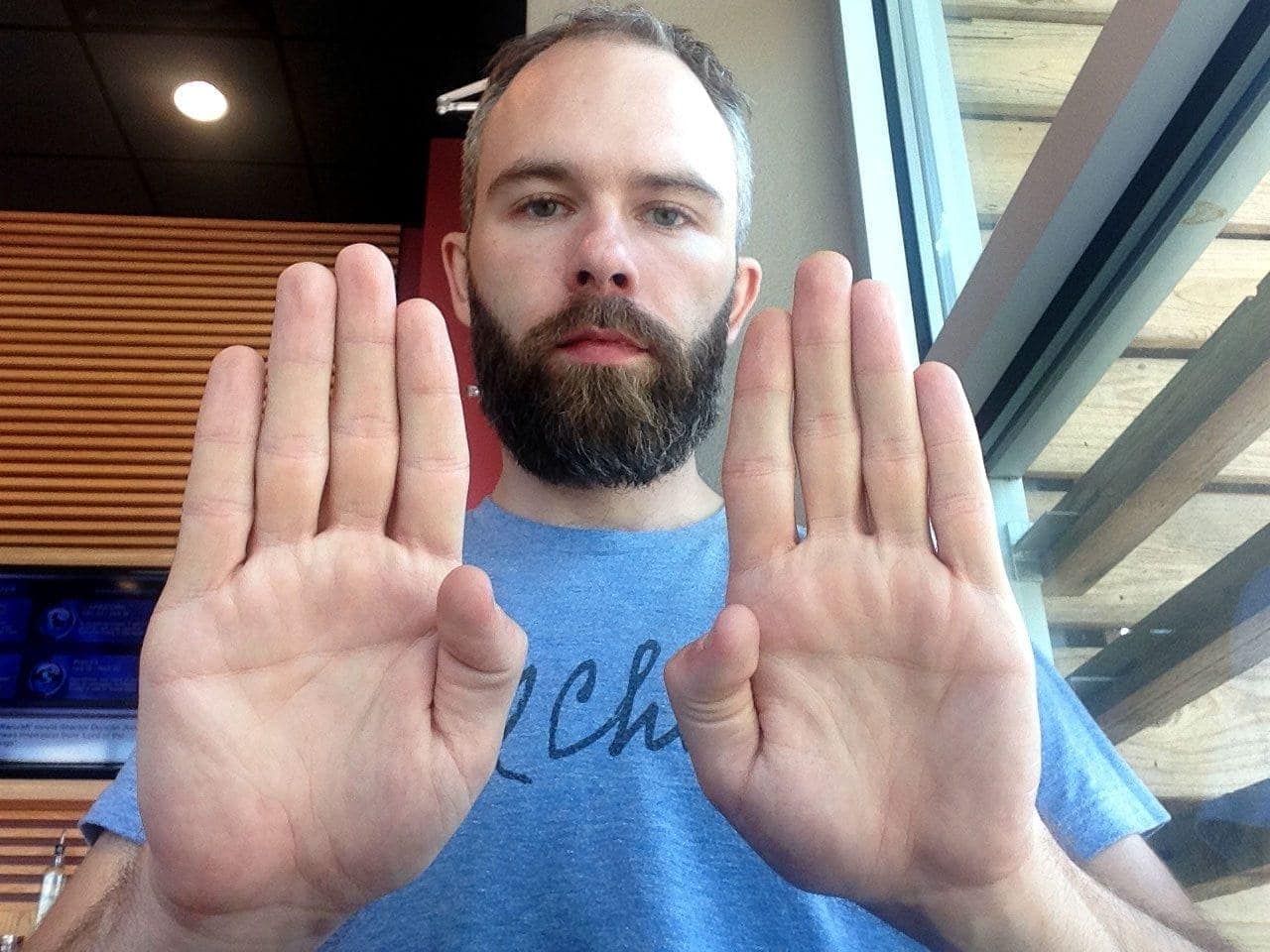 Simian Line - What a Palm Reader Told Me About My Rare Hands