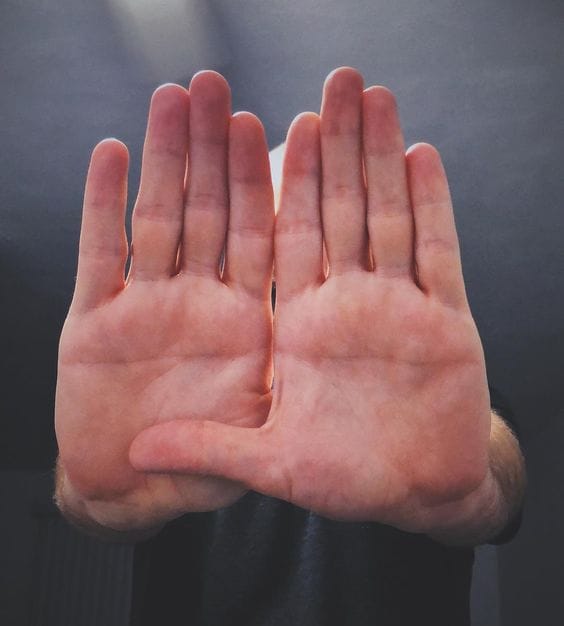 Simian Line - What a Palm Reader Told Me About My Rare Hands